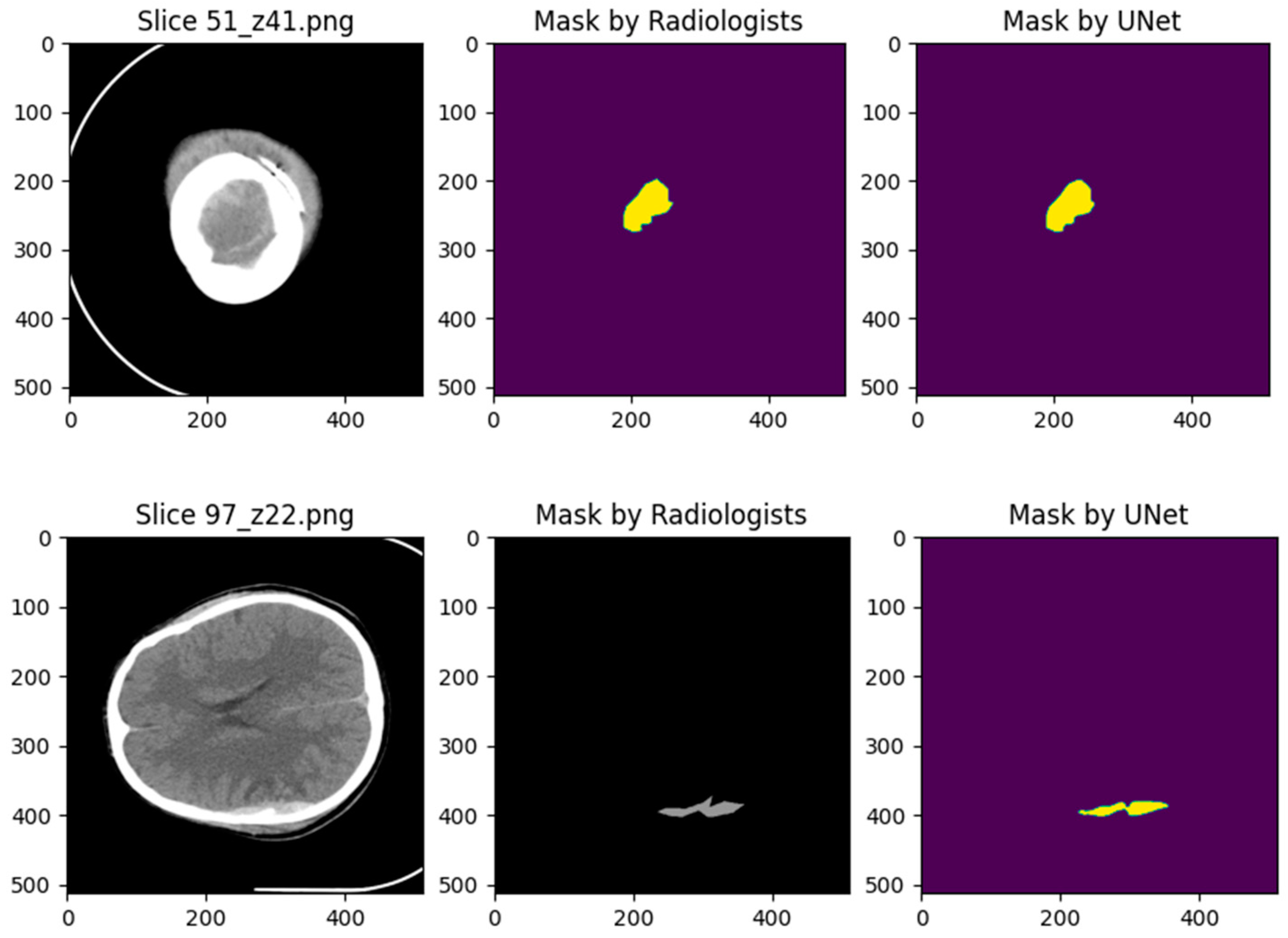 An Efficient CNN-Based Method for Intracranial Hemorrhage Segmentation ...