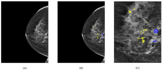 Automatic Detection of Post-Operative Clips in Mammography Using a U-Net Convolutional Neural ...