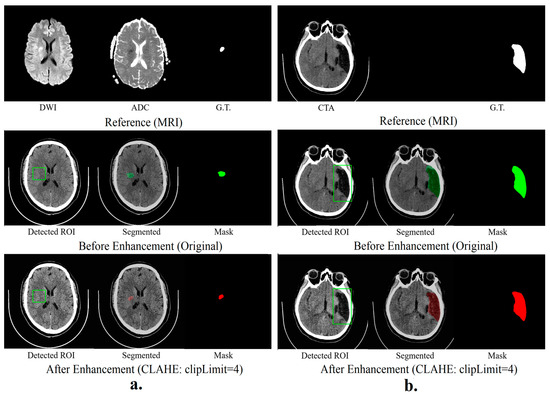 Hybrid Ensemble Deep Learning Model For Advancing Ischemic Brain Stroke Detection And