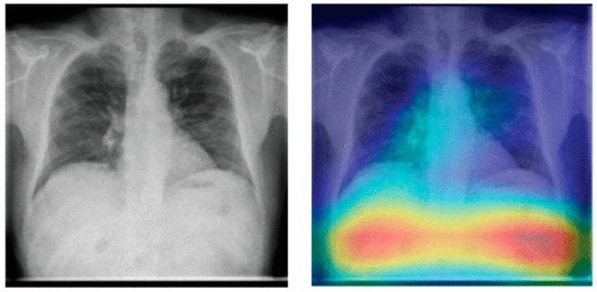 Deep Learning for Pneumonia Detection in Chest X-ray Images: A ...