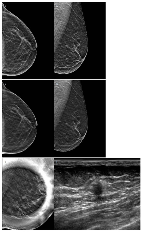Special Types of Breast Cancer: Clinical Behavior and Radiological ...