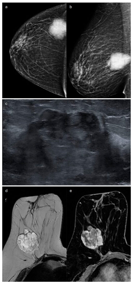 Special Types of Breast Cancer: Clinical Behavior and Radiological ...