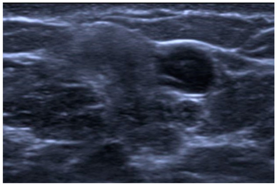 Special Types of Breast Cancer: Clinical Behavior and Radiological ...