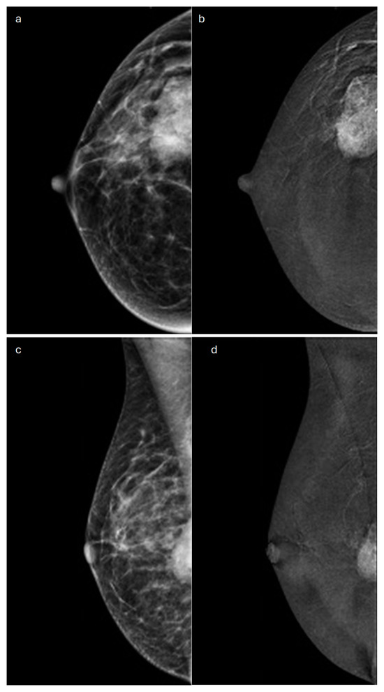 Special Types of Breast Cancer: Clinical Behavior and Radiological ...