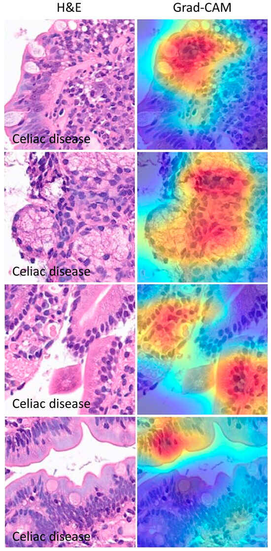 Celiac Disease Deep Learning Image Classification Using Convolutional ...