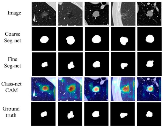 A Multi-Task Model for Pulmonary Nodule Segmentation and Classification