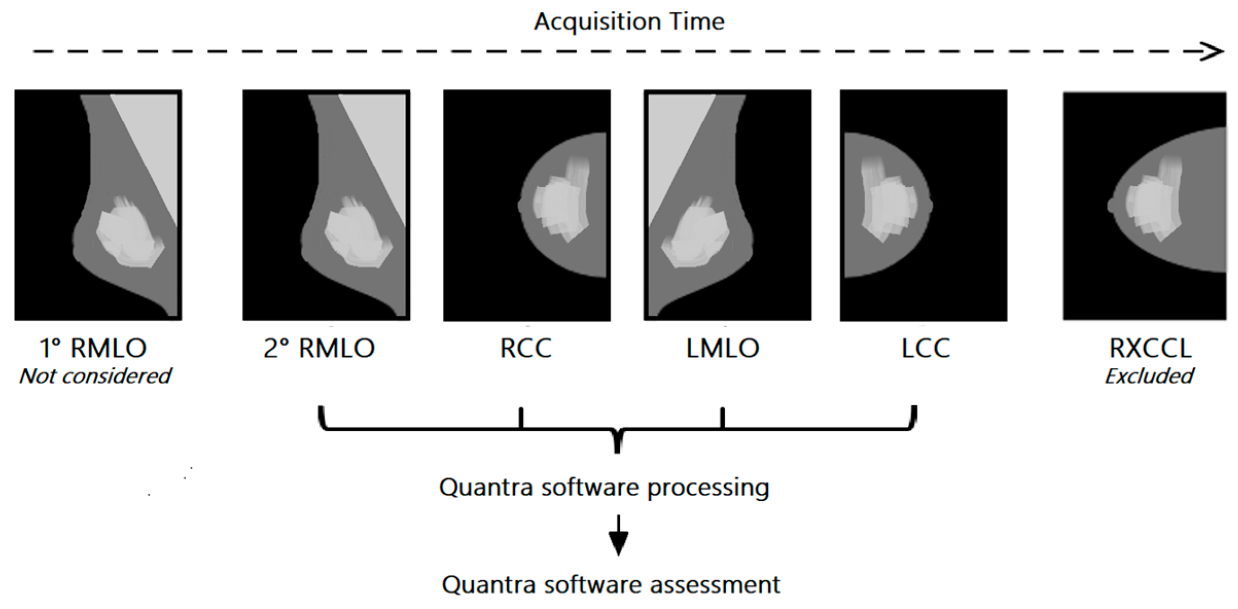 Comparison of Visual and Quantra Software Mammographic Density Assessment According to BI-RADS ...