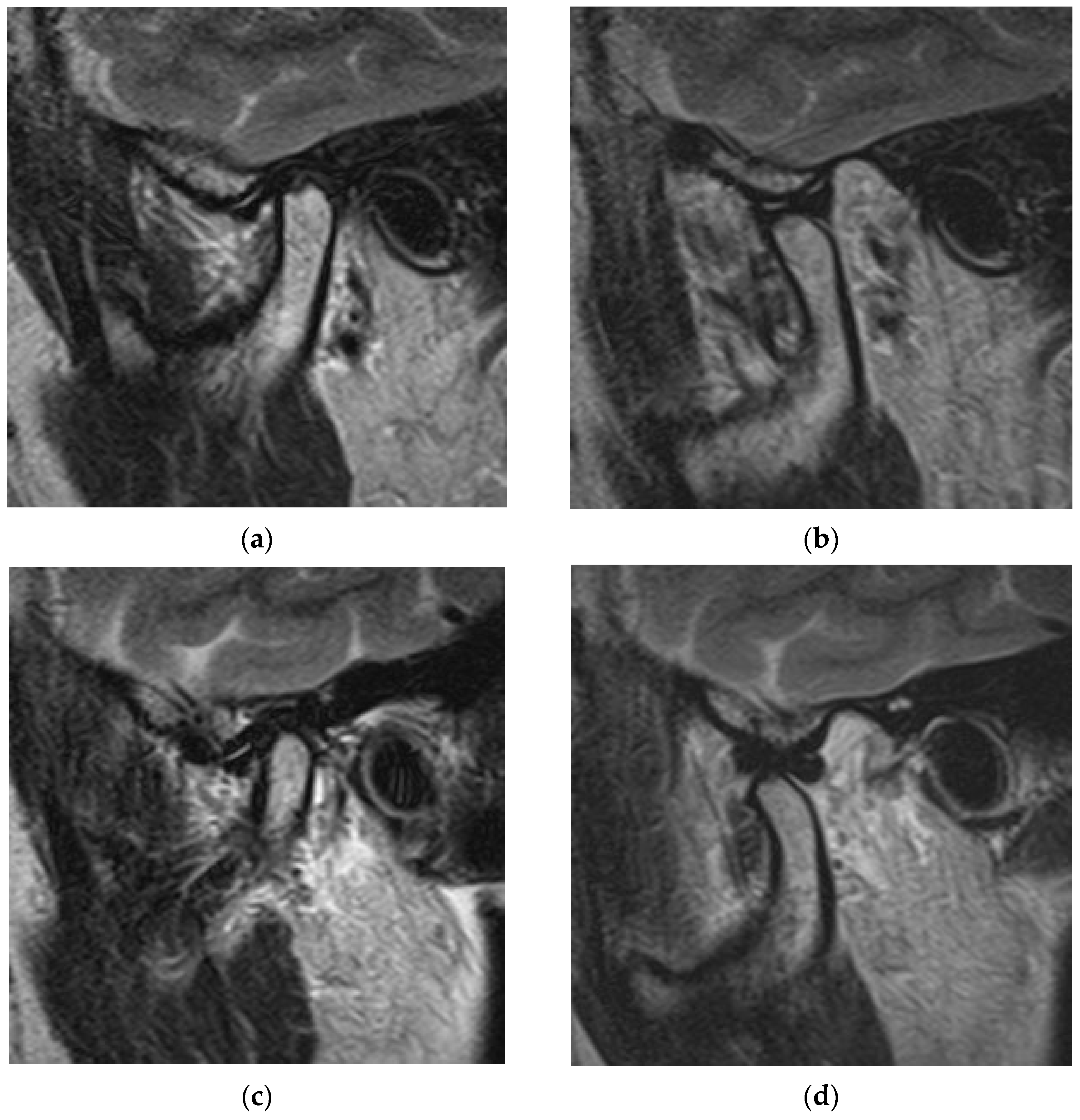 Examination of Joint Effusion Magnetic Resonance Imaging of Patients ...