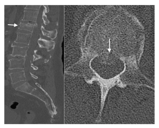 Radiological Diagnosis and Advances in Imaging of Vertebral Compression ...