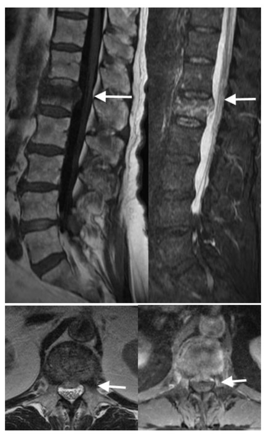 T12 Burst Fracture Mri