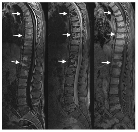Radiological Diagnosis and Advances in Imaging of Vertebral Compression ...