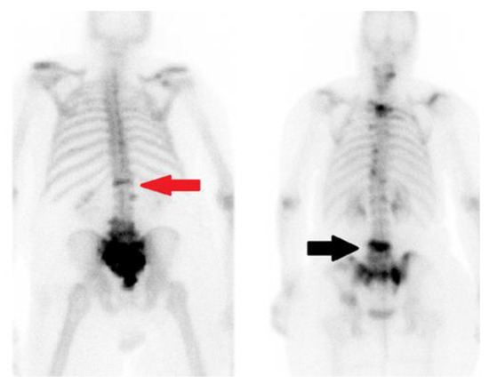 Radiological Diagnosis and Advances in Imaging of Vertebral Compression ...