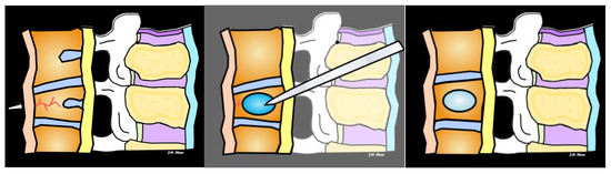 Radiological Diagnosis and Advances in Imaging of Vertebral Compression ...