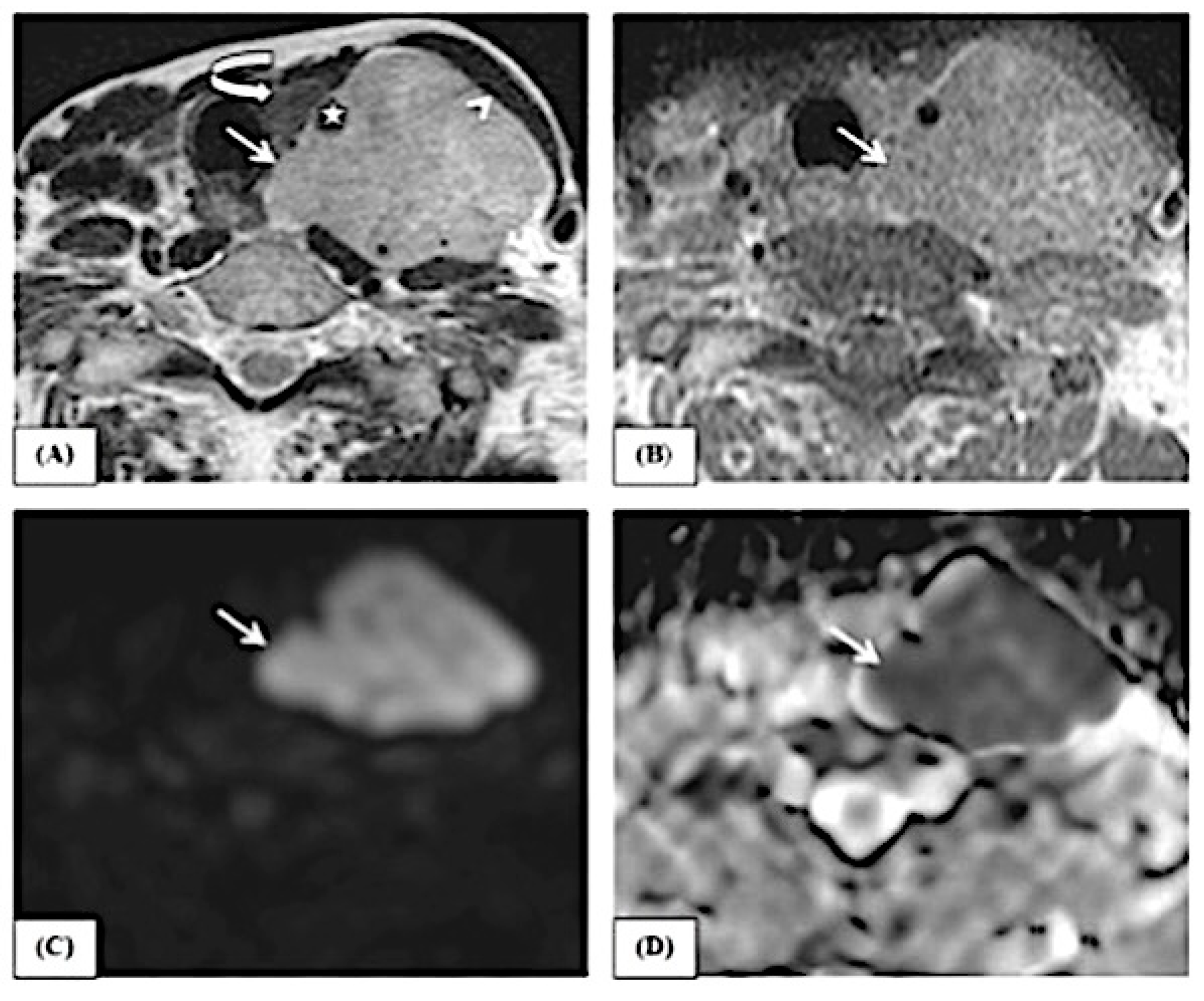 Differentiation of Benign and Malignant Neck Neoplastic Lesions Using ...