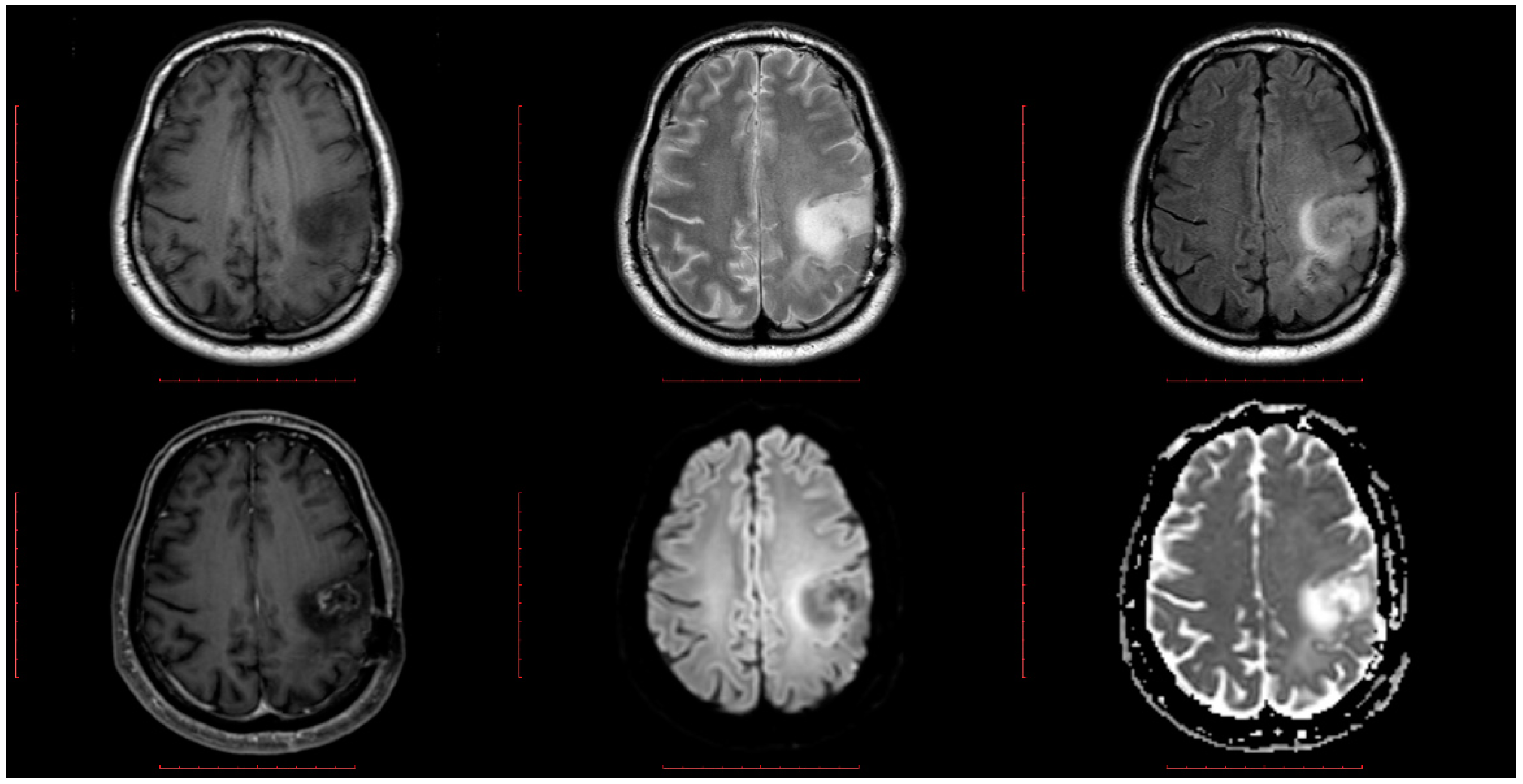 Evaluating Brain Tumor Detection With Deep Learning Convolutional Neural Networks Across