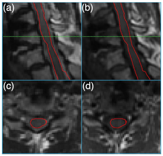 Quantitative MRI Assessment of Post-Surgical Spinal Cord Injury Through ...