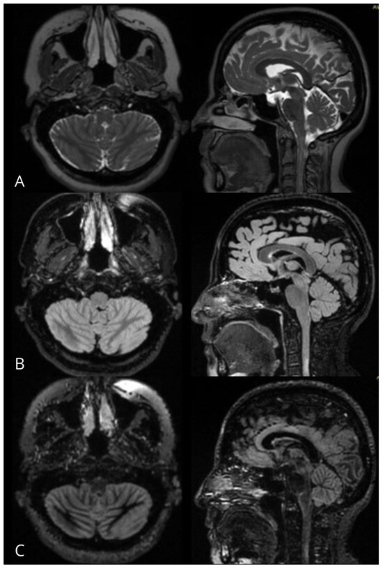 Unmasking the Area Postrema on MRI: Utility of 3D FLAIR, 3D-T2, and 3D ...