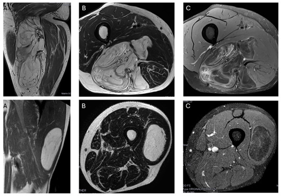 Differentiation of Atypical Lipomatous Tumors from Lipomas: Our ...