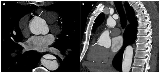 Computed Tomography Imaging of Thoracic Aortic Surgery: Distinguishing ...