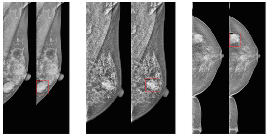 Enhancing Breast Lesion Detection in Mammograms via Transfer Learning