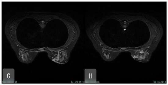 A Pictorial Review on Mastitis: Clinical Aspects, Imaging Features and ...