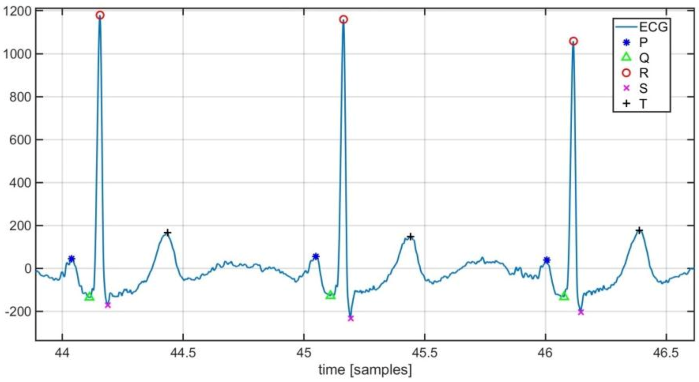 FPGA-Based Decision Support System for ECG Analysis
