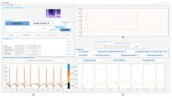 FPGA-Based Decision Support System for ECG Analysis