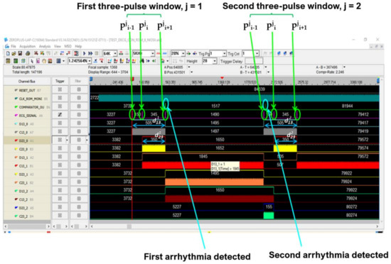 FPGA-Based Decision Support System for ECG Analysis
