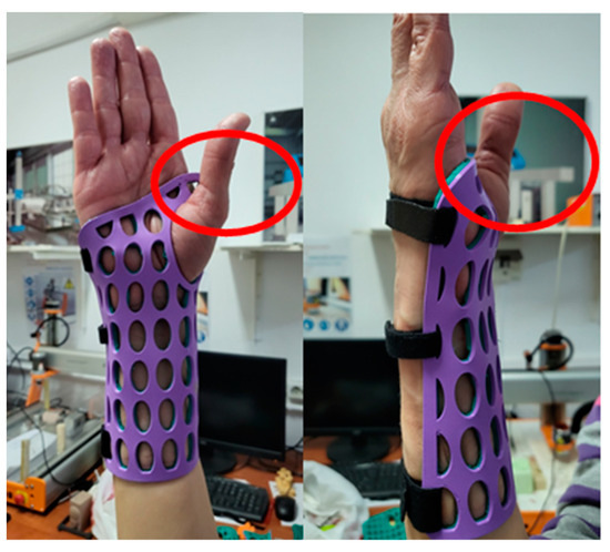 Exploring a Novel Material and Approach in 3D-Printed Wrist-Hand Orthoses