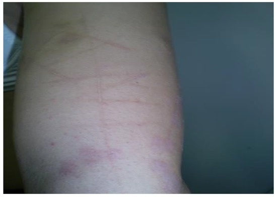 Pathological Skin Picking: Case Presentation and Review of the Literature