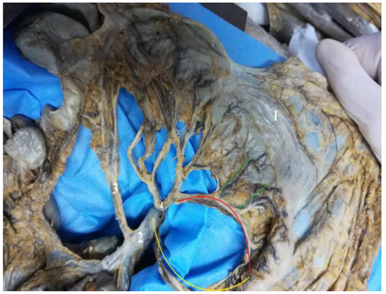Arterial Vascularization of the Colon; A Guide to Surgical Resection