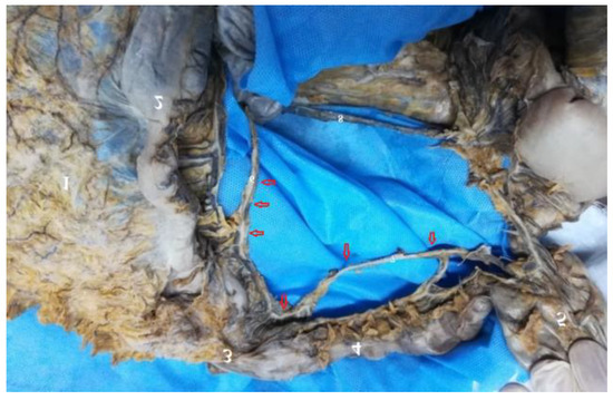 Arterial Vascularization of the Colon; A Guide to Surgical Resection