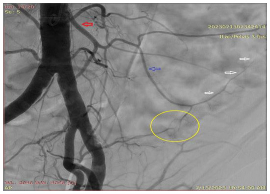Arterial Vascularization of the Colon; A Guide to Surgical Resection