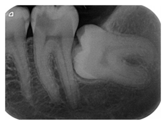 Deep Caries Lesions Revisited: A Narrative Review