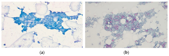 The Value of Fine Needle Aspiration Biopsy in the Pre-Operative ...