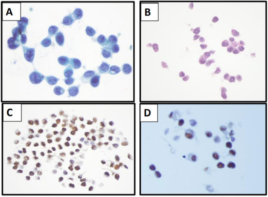 Comprehensive Review of Metastatic Breast Carcinoma in Cytology Specimens