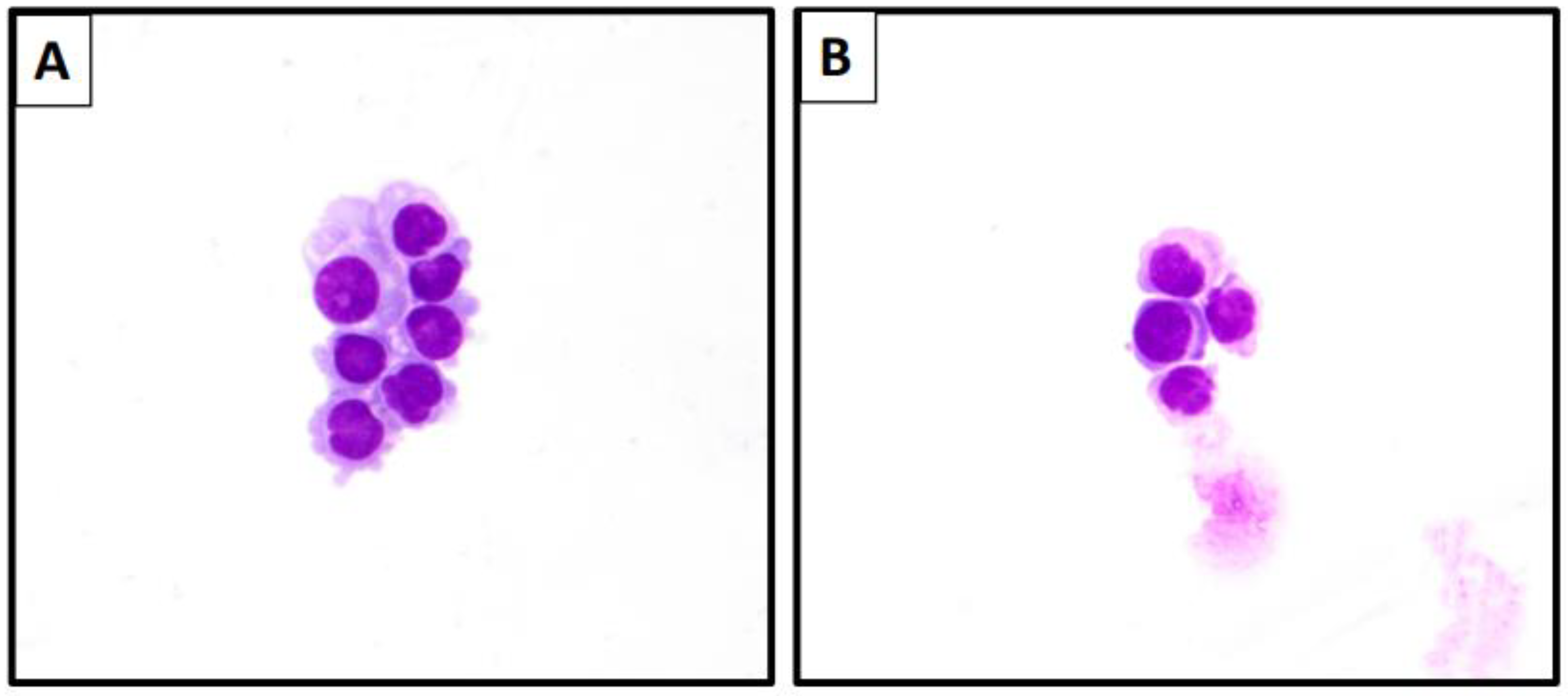 Comprehensive Review of Metastatic Breast Carcinoma in Cytology Specimens