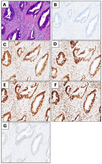 JMP | Free Full-Text | DNA Mismatch Repair Proteins and BRAF V600E Detection by ...