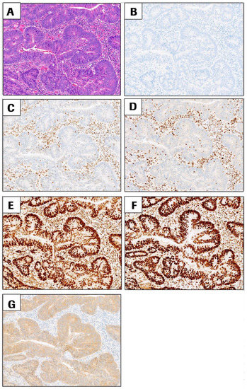 JMP | Free Full-Text | DNA Mismatch Repair Proteins and BRAF V600E Detection by ...