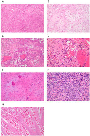 Different Subtypes of Osteosarcoma: Histopathological Patterns and ...