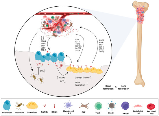 Different Subtypes of Osteosarcoma: Histopathological Patterns and ...