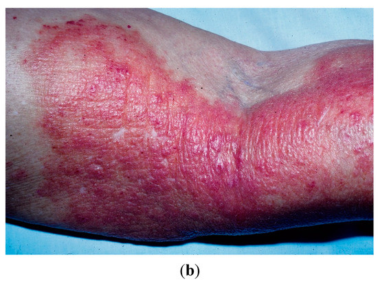 Cutaneous Protothecosis in a Patient with Chronic Lymphocytic Leukemia ...