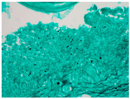 Sporotrichosis: From KOH to Molecular Biology