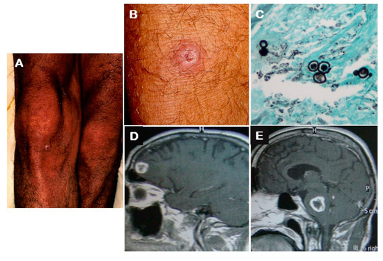 JoF | Special Issue : Paracoccidioides and Paracoccidioidomycosis
