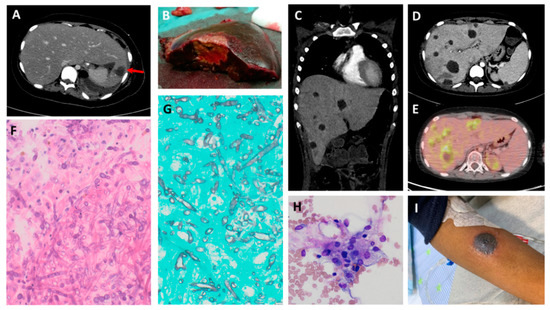 Disseminated Mucormycosis in Immunocompromised Children: Are New ...