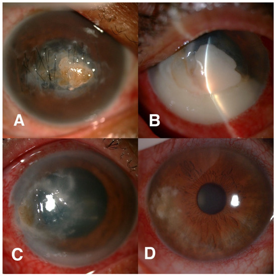 The Clinical Features and Prognostic Factors for Treatment Outcomes of ...