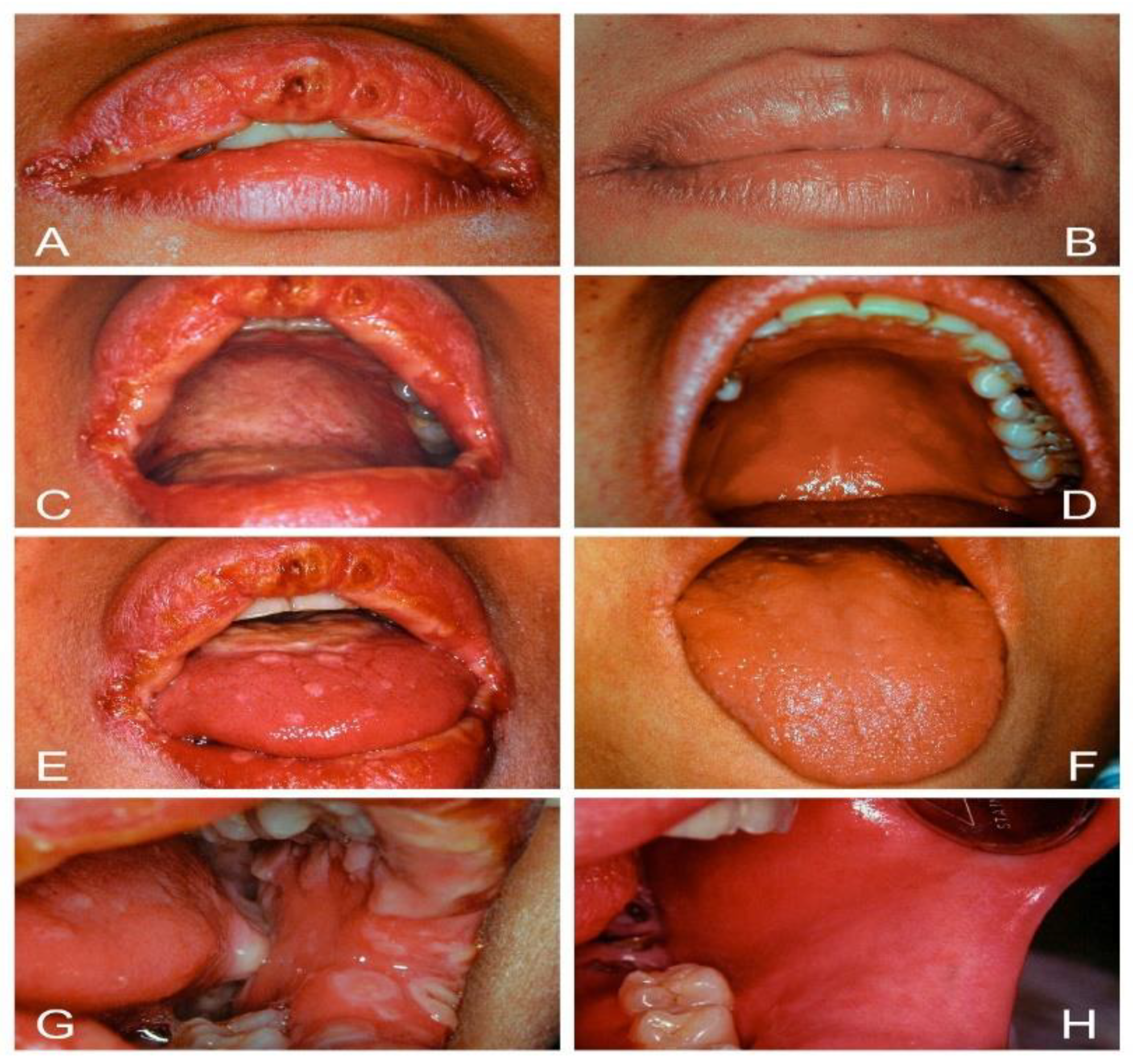 Recurrent oral thrush store