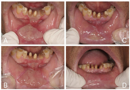 JoF | Free Full-Text | Oral Candidosis: Pathophysiology and Best ...