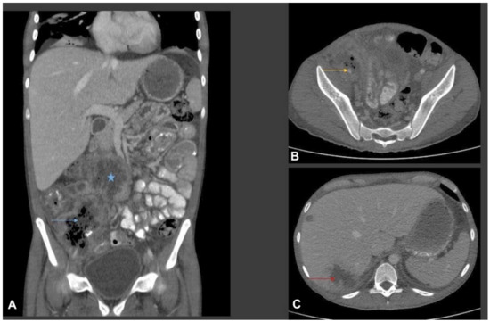 Basidiobolus omanensis sp. nov. Causing Angioinvasive Abdominal ...