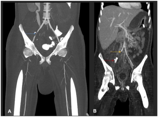Basidiobolus omanensis sp. nov. Causing Angioinvasive Abdominal ...